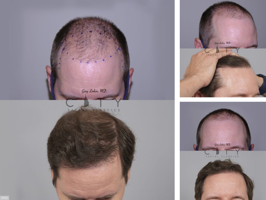Alopecia Treatment NYC | Hereditary Alopecia Treatment in New York City